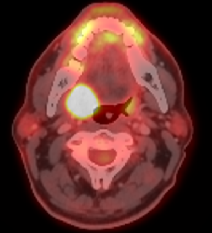 Estudiarán epidemiología de cáncer orofaríngeo causado por virus ...